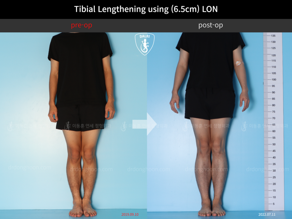Tibial Lengthening using (6.5cm) LON : 3yrs post-op : DALRI before & after