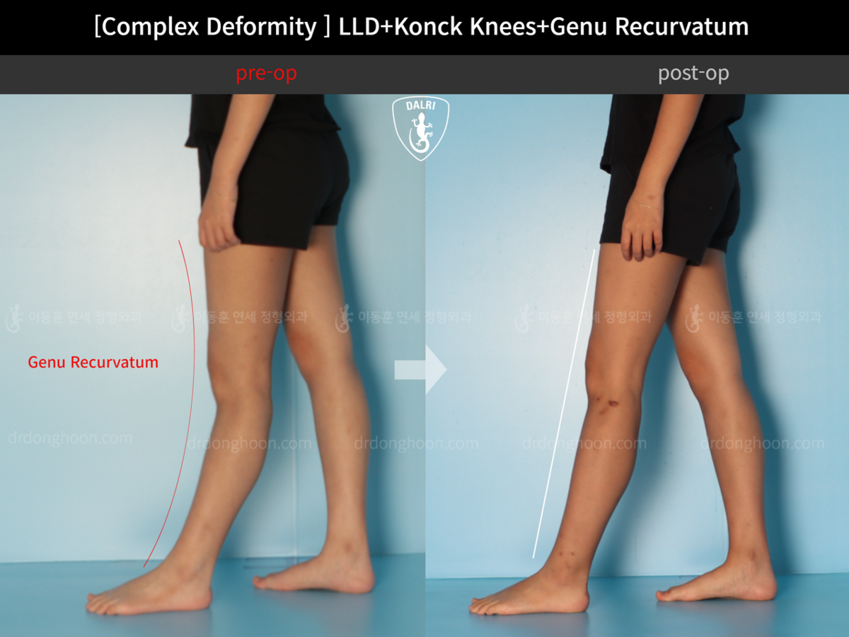 [Complex Deformity ] LLD+Konck Knees+Genu Recurvatum : Genu Recurvatum