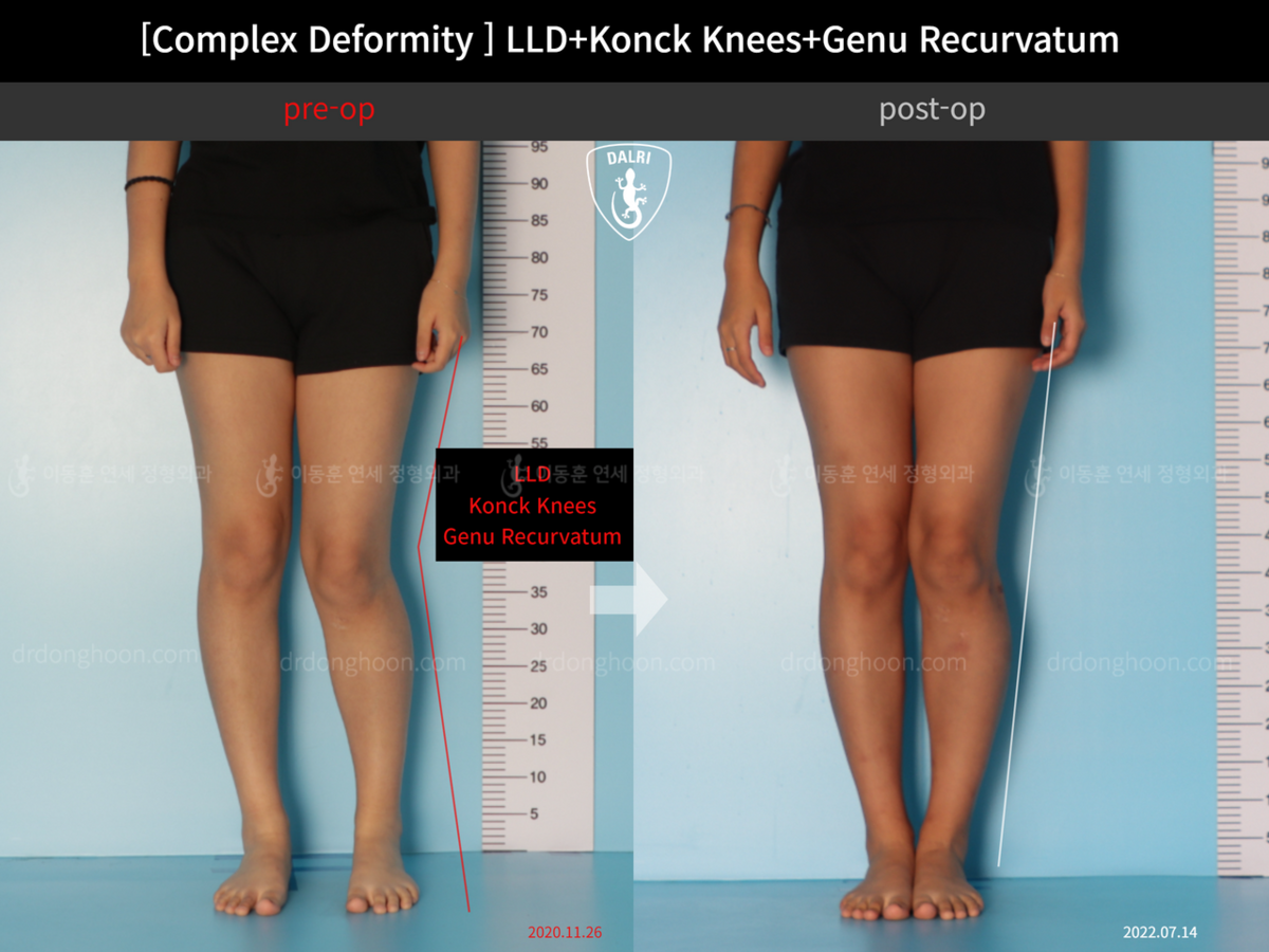 [Complex Deformity ] LLD+Konck Knees+Genu Recurvatum : Adult LLD