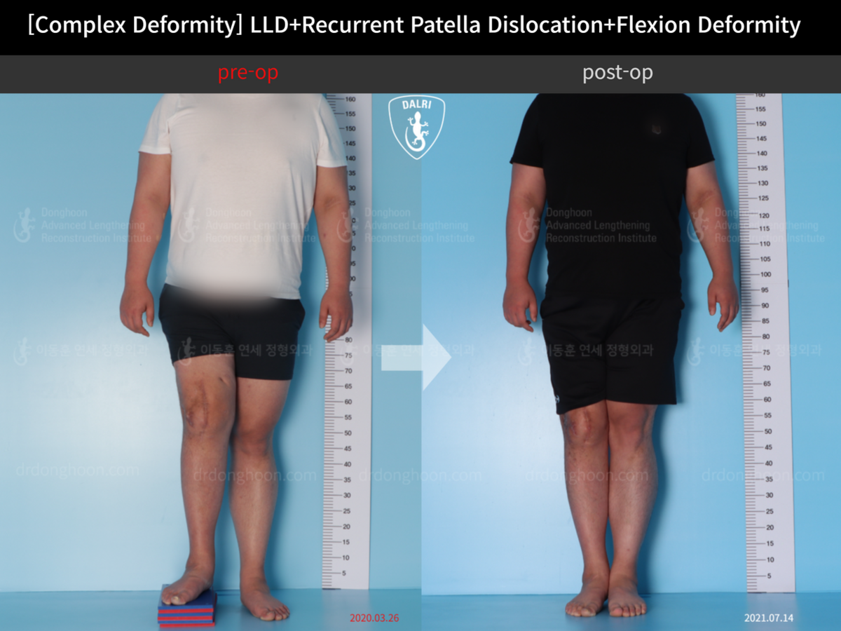[Complex Deformity] LLD+Recurrent Patella Dislocation+Flexion Deformity ...