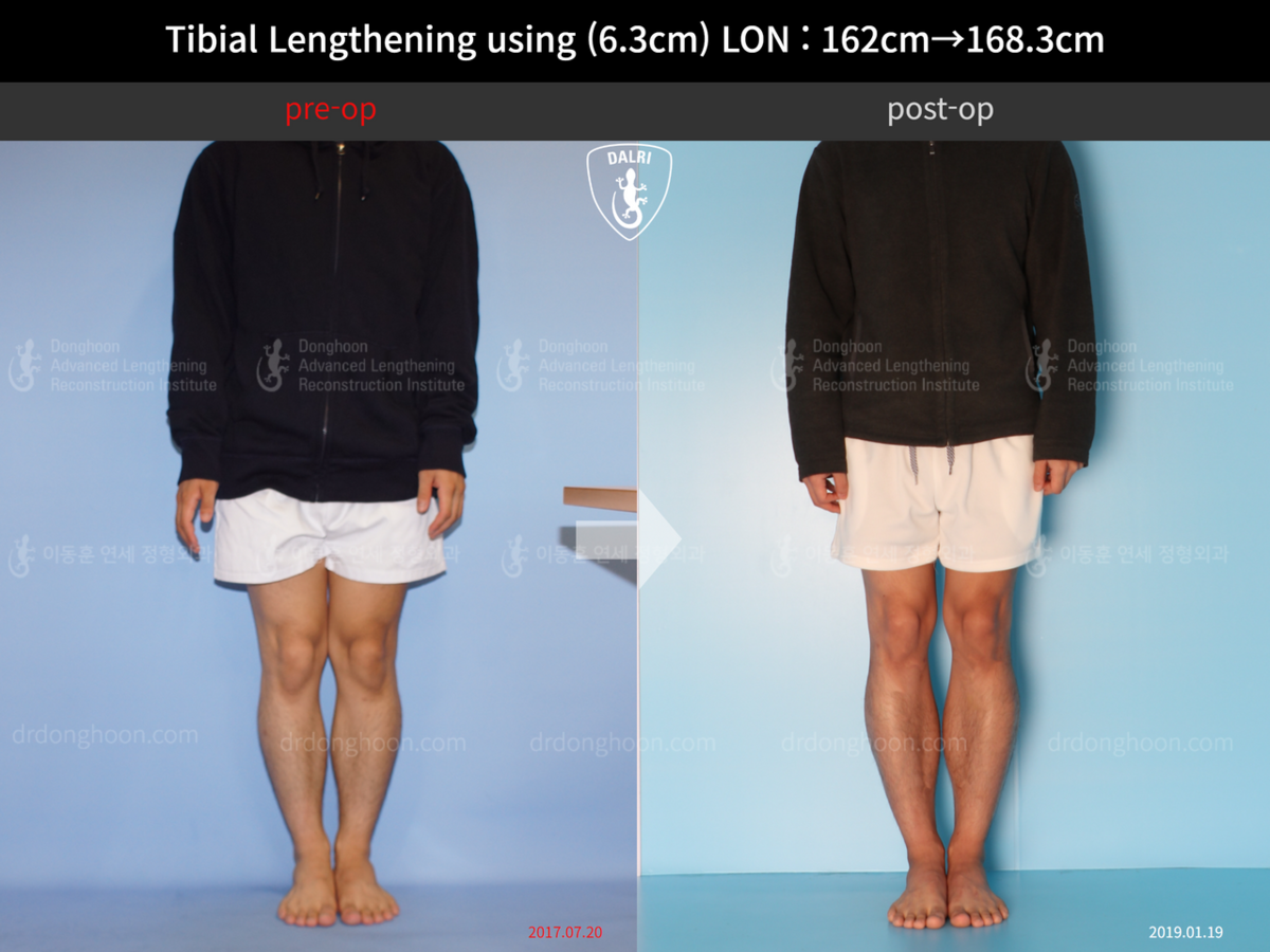 Tibial Lengthening using (6.3cm) LON : 162cm→168.3cm : DALRI before & after