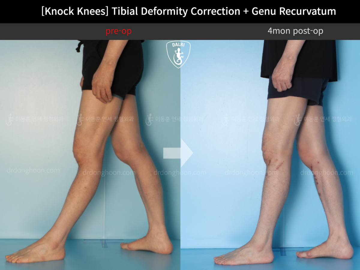 [Knock Knees] Tibial Deformity Correction + Genu Recurvatum : Genu ...