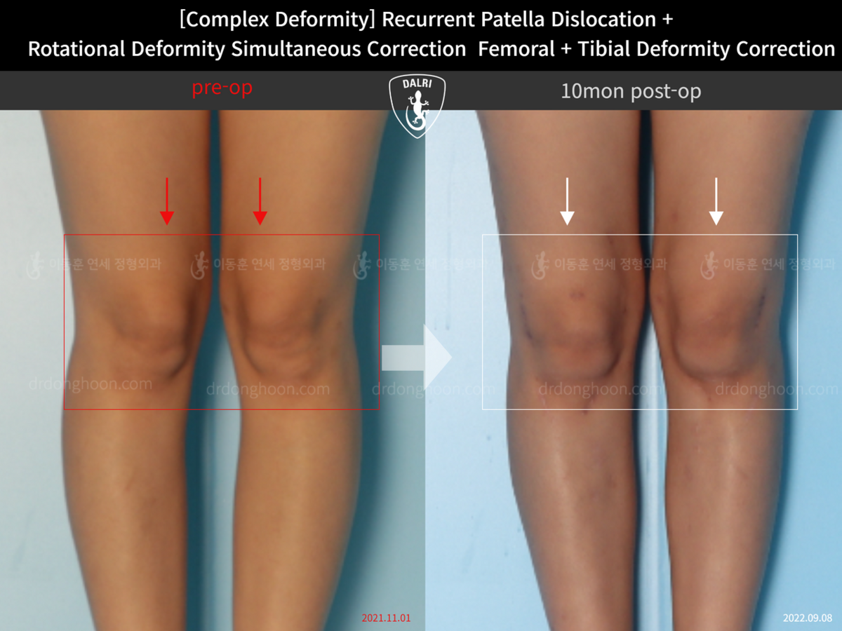 [Complex Deformity] Recurrent Patella Dislocation+Rotational Deformity ...