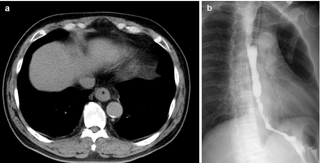 (Japan) A case of eosinophilic esophagitis with autoimmune ...
