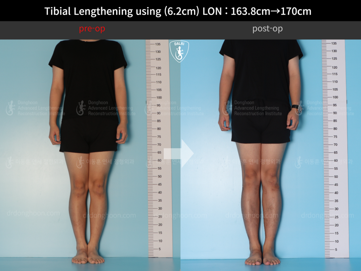 Tibial Lengthening using (6.2cm) LON : 163.8cm→170cm : 1yr post-op ...