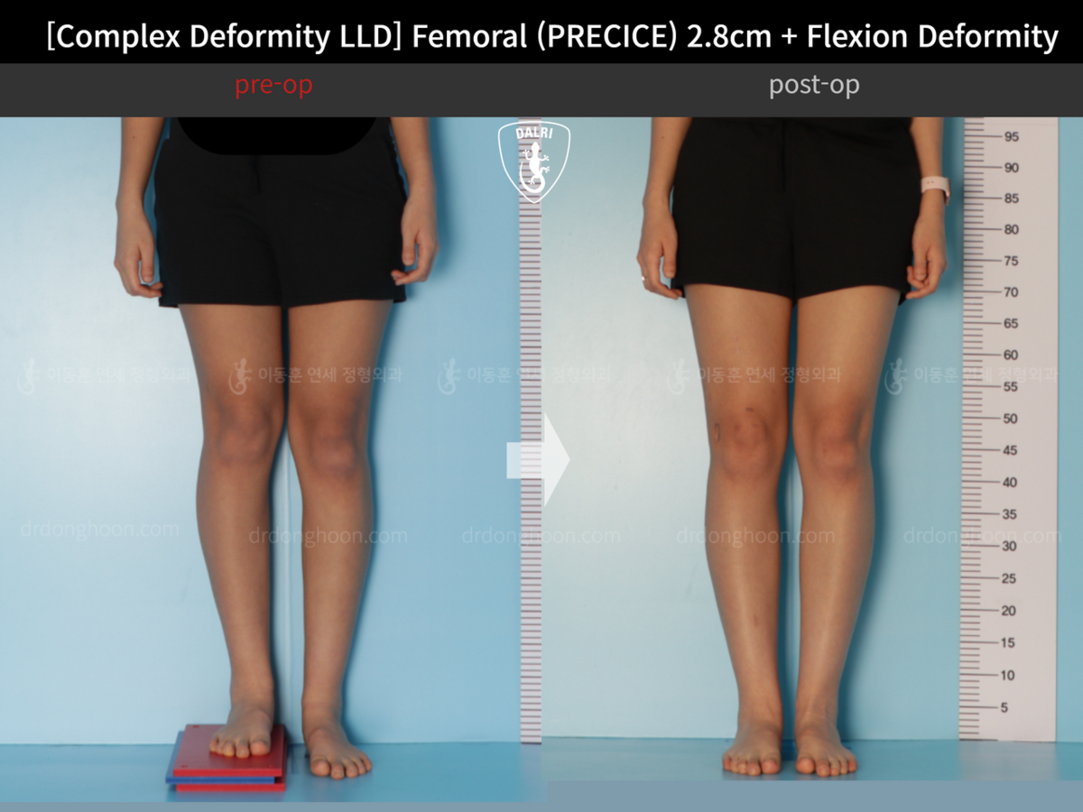 [Complex Deformity LLD] Femoral (PRECICE) 2.8cm + Flexion Deformity ...