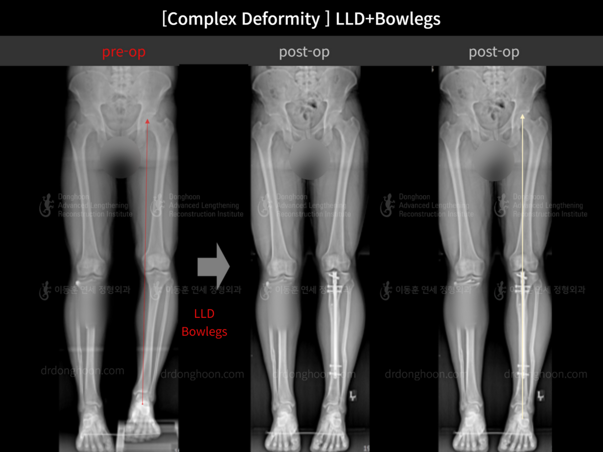 [Complex Deformity ] LLD+Bowlegs : Complex Deformity