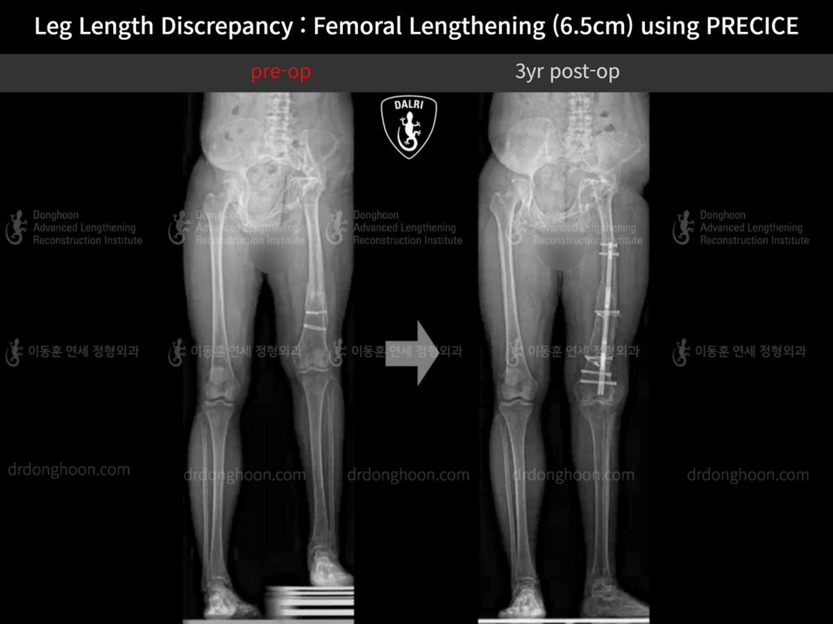 Leg Length Discrepancy : Femoral Lengthening (6.5cm) using PRECICE ...