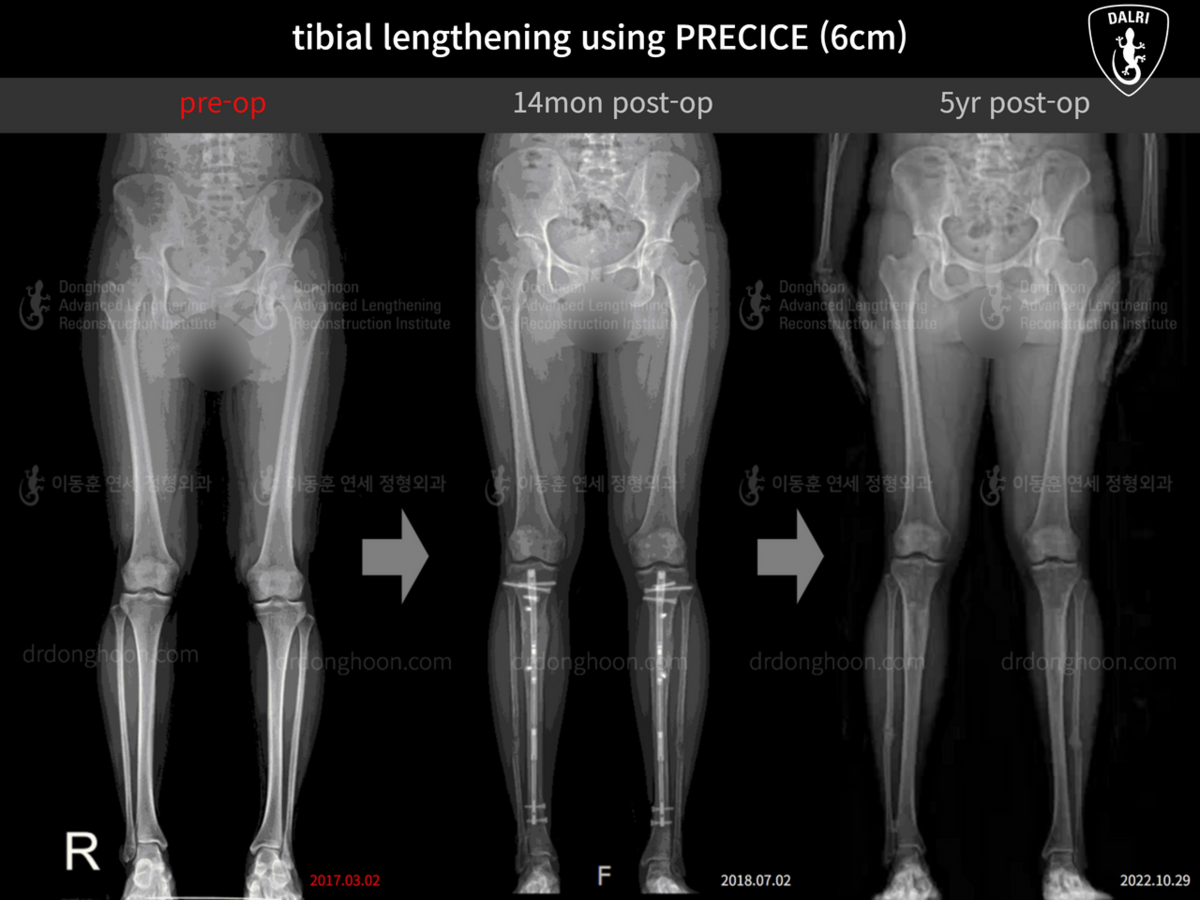 tibial lengthening using PRECICE (6cm) : CLL PRECICE
