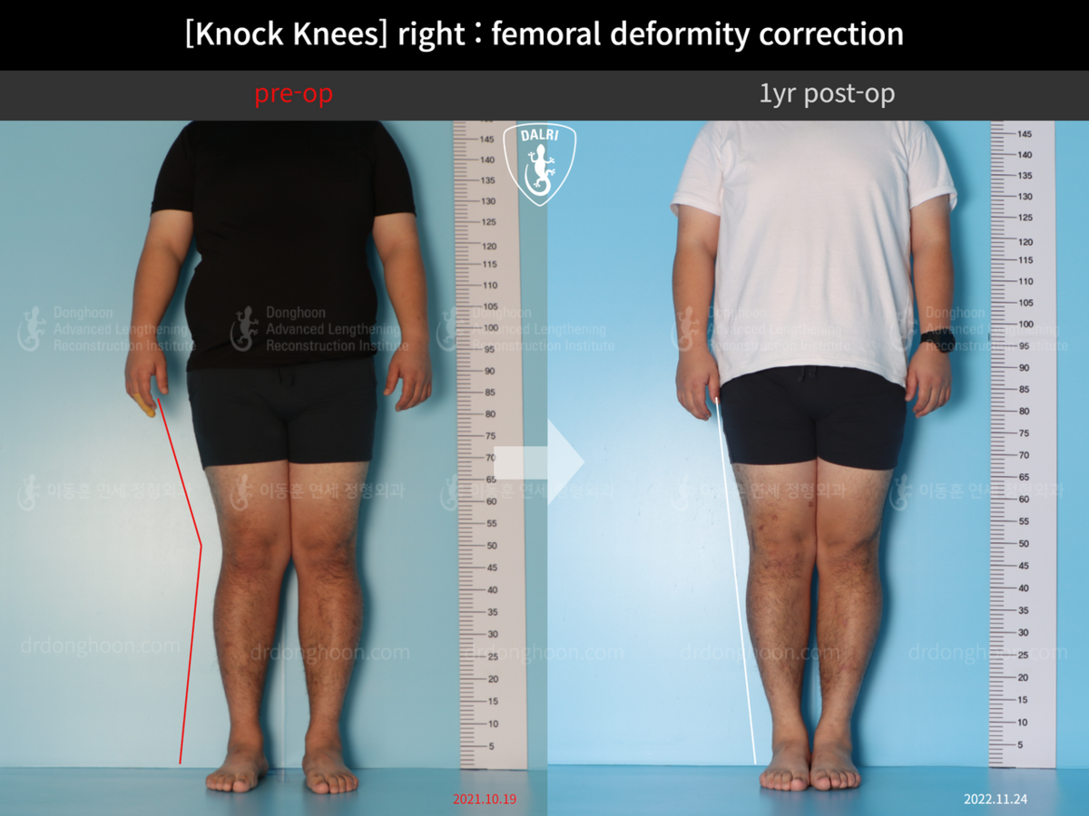 [Knock Knees] right : femoral deformity correction : 1yr post-op ...