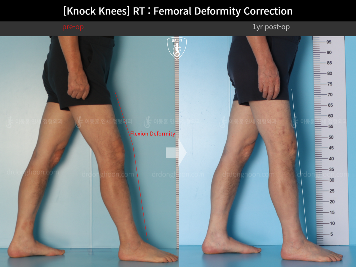 [Knock Knees] RT : Femoral Deformity Correction + Flexion Deformity ...
