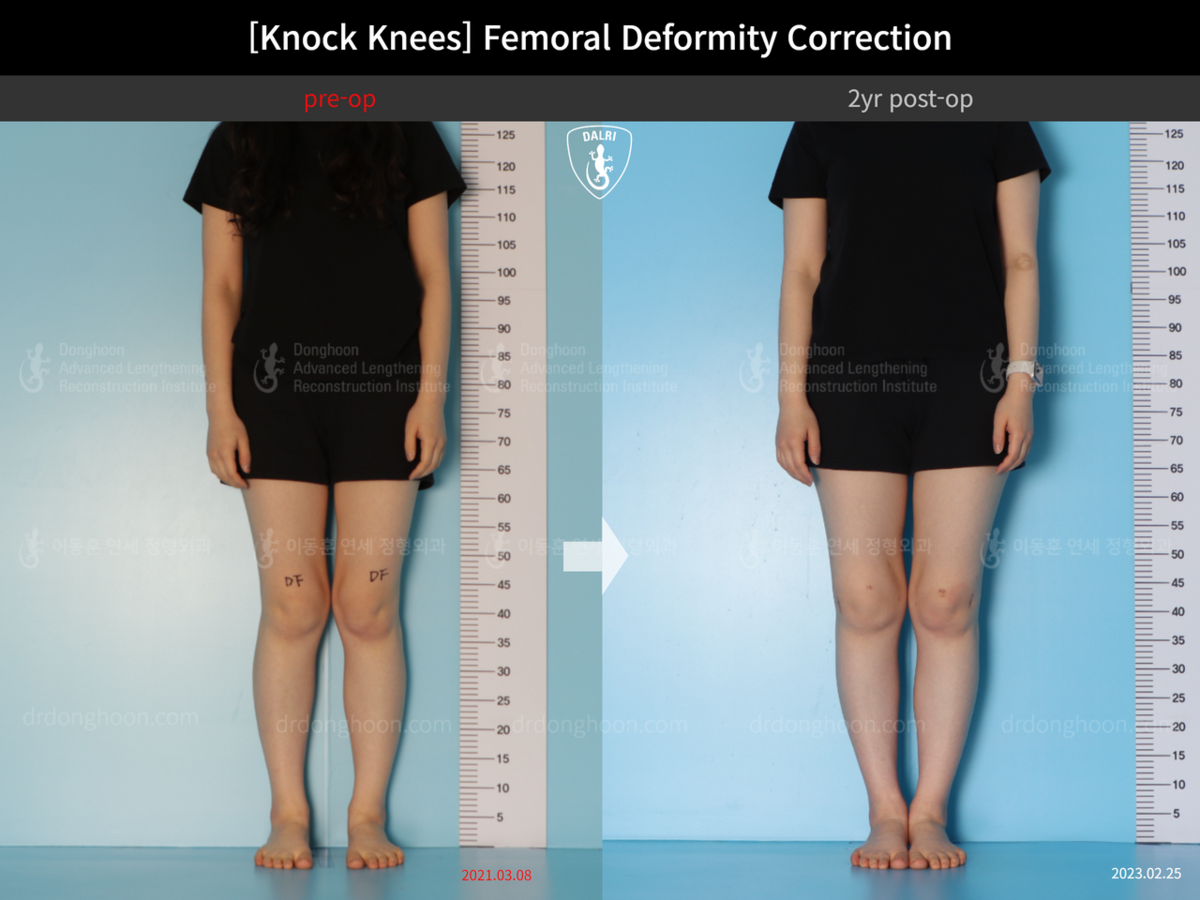 [Knock Knees] Femoral Deformity Correction : 2wks→2yr post-op+scars ...
