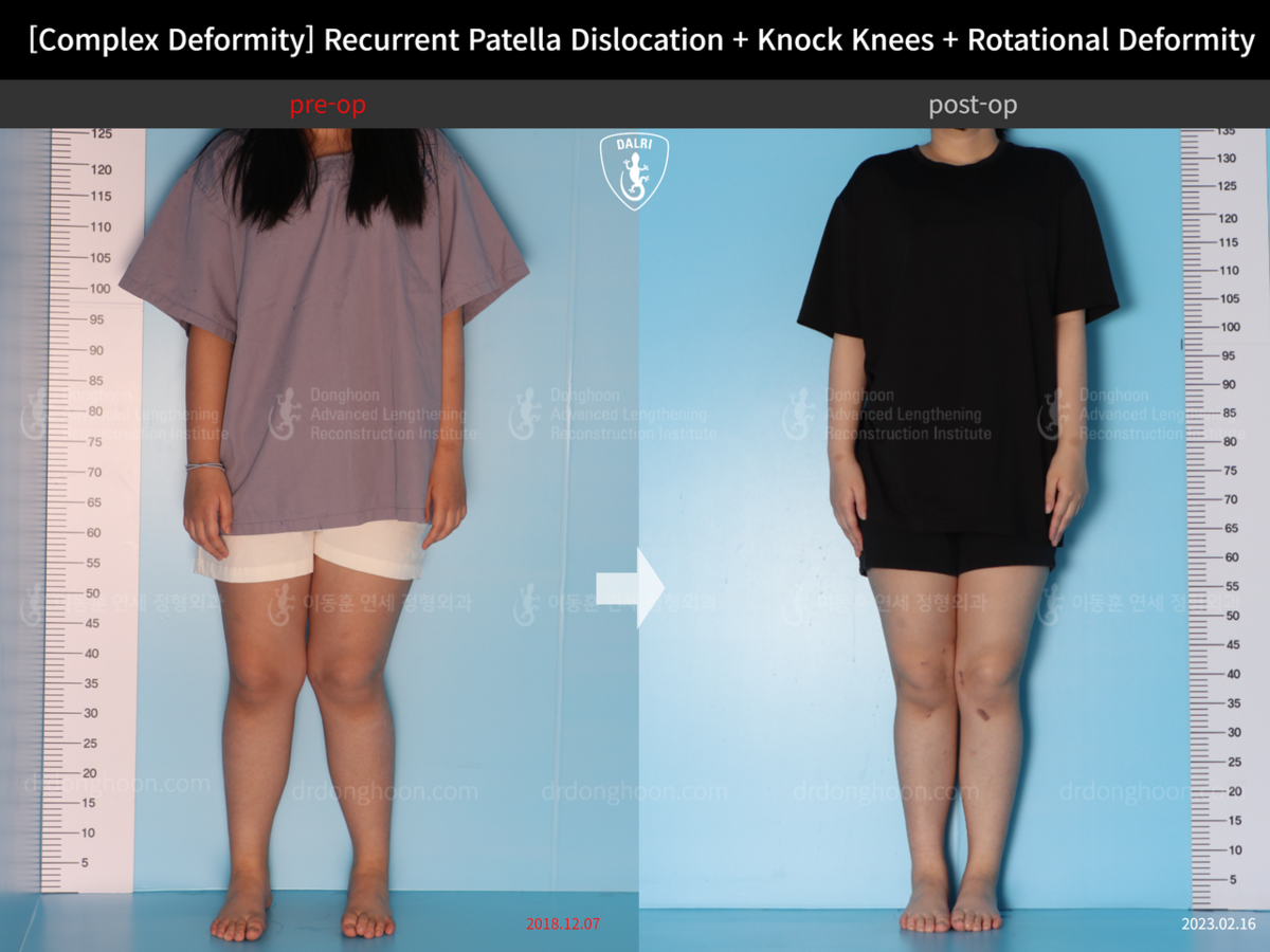 [Complex Deformity] Recurrent Patella Dislocation + Knock Knees ...