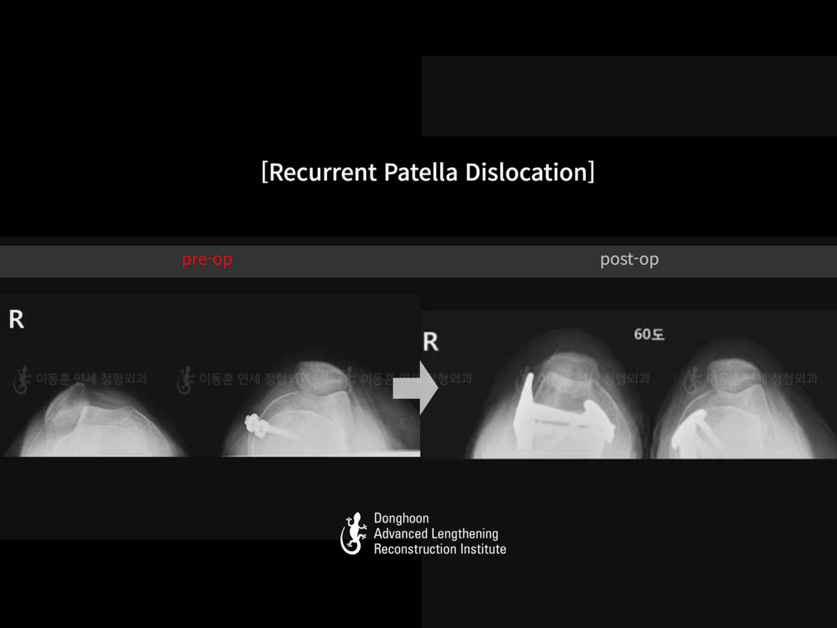 [Complex Deformity] Recurrent Patella Dislocation + Knock Knees ...