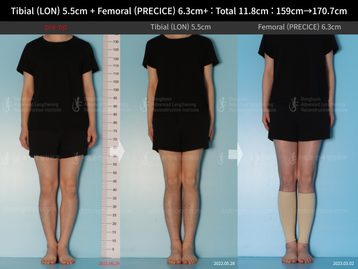 Tibial (LON) 5.5cm + Femoral (PRECICE) 6.3cm+ : Total 11.8cm : 159cm→170.8cm : 20mon post-op ...