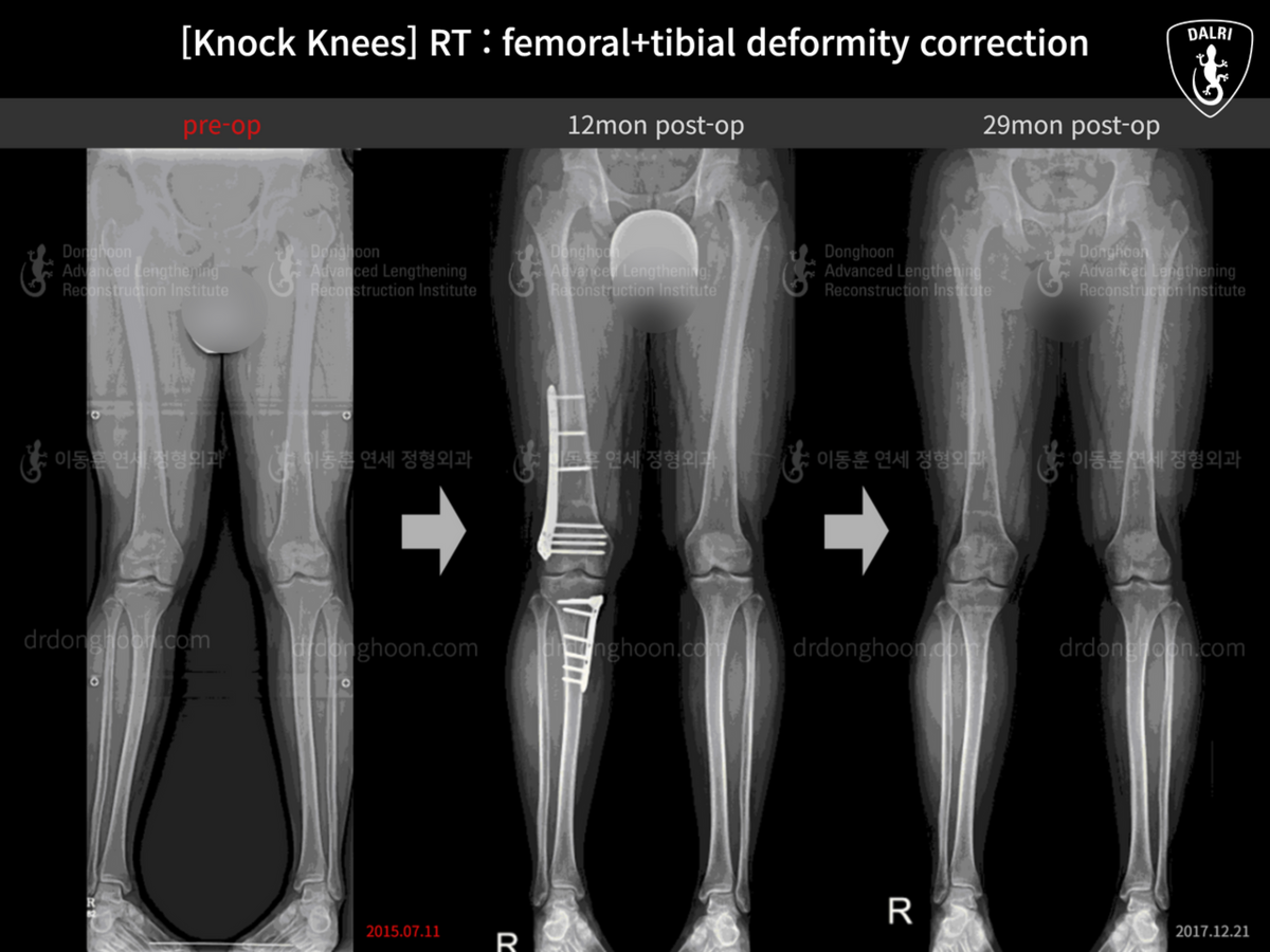 [Knock Knees] RT : femoral+tibial deformity correction : Adult knock knees