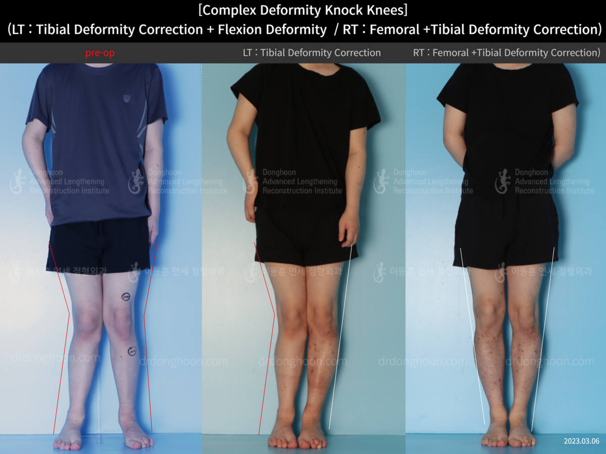 [Complex Deformity Knock Knees] (LT : Tibial Deformity Correction ...