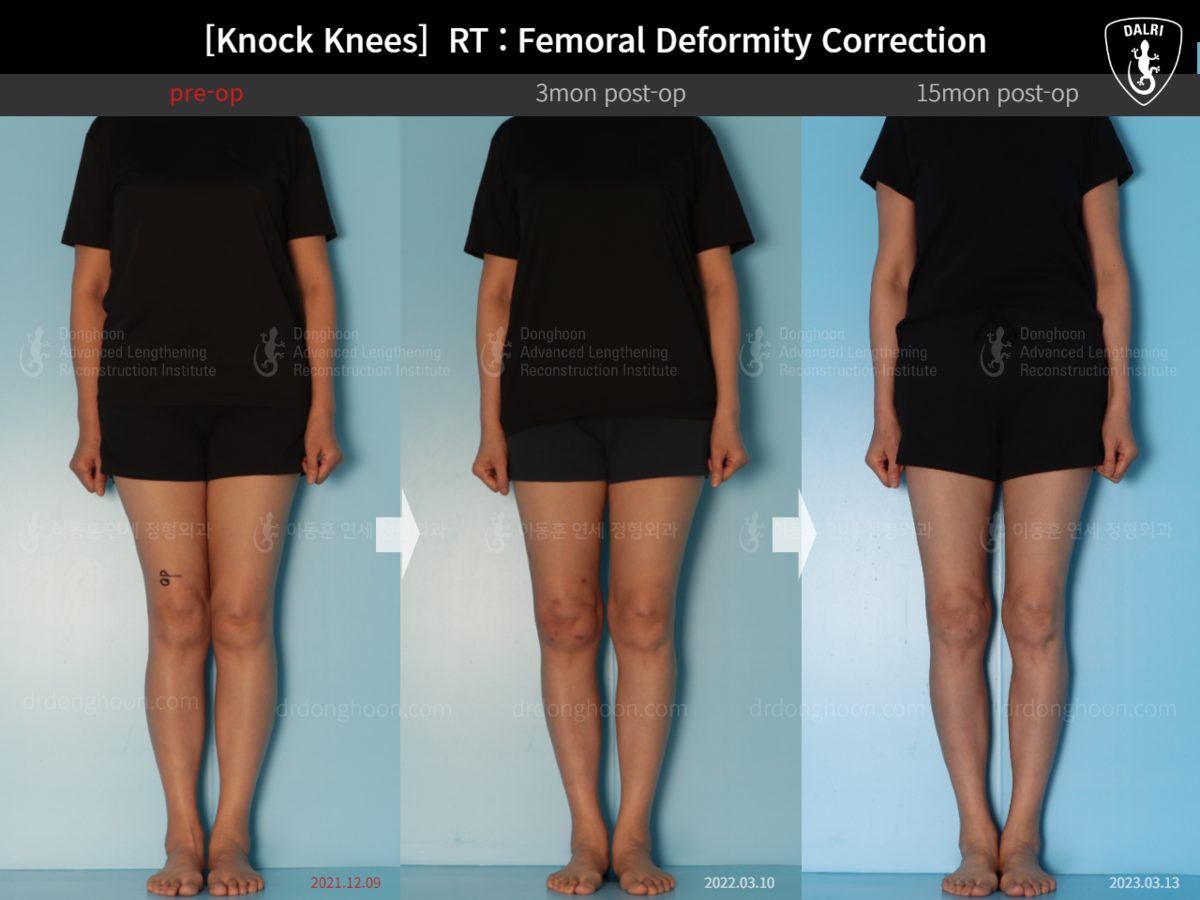 [Knock Knees] RT : Femoral Deformity Correction : Adult knock knees