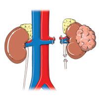 Partial nephrectomy : INFOGRAPHY (인포그라피)