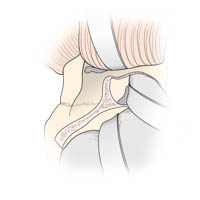 Brain suergery (Petrosal approach) : INFOGRAPHY (인포그라피)