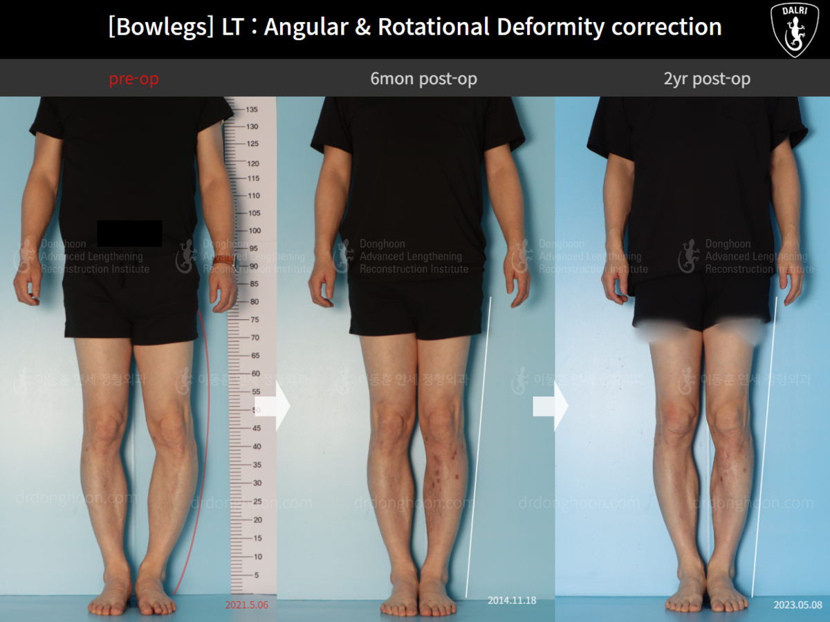 [Bowlegs] LT : Angular & Rotational Deformity correction : Adult Bowlegs
