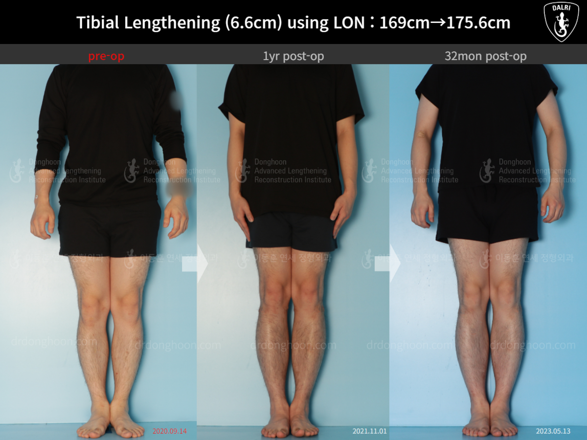 Tibial Lengthening (6.6cm) using LON : 169cm→175.6cm : DALRI before & after
