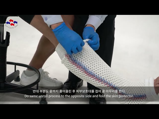 HM Cast procedure (Short leg) : New Cast Industry Co., Ltd.-Product ...