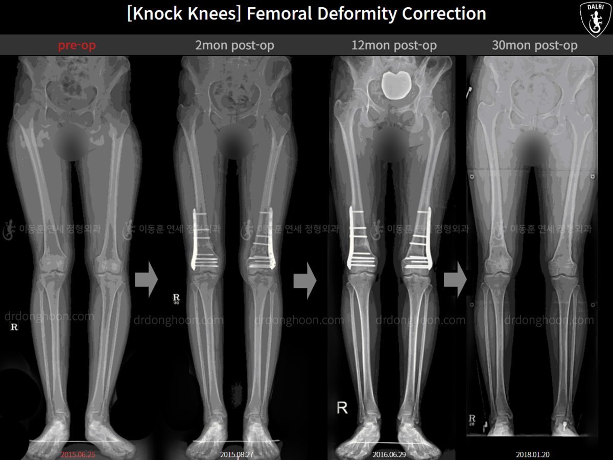 [Knock Knees] Femoral Deformity Correction : Adult knock knees