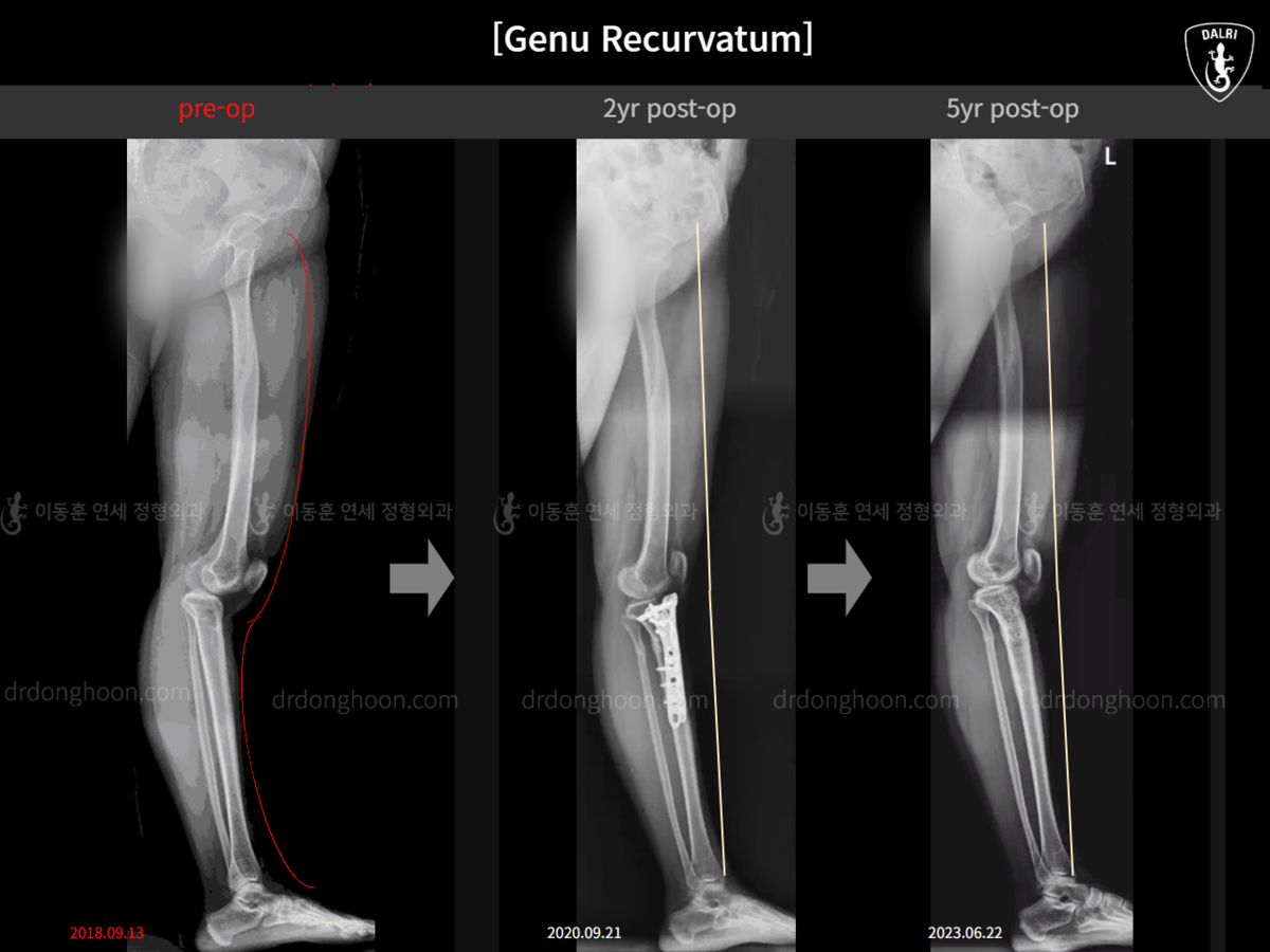 [Complex Deformity Knock Knees] LT : Tibial Deformity Correction + Genu ...