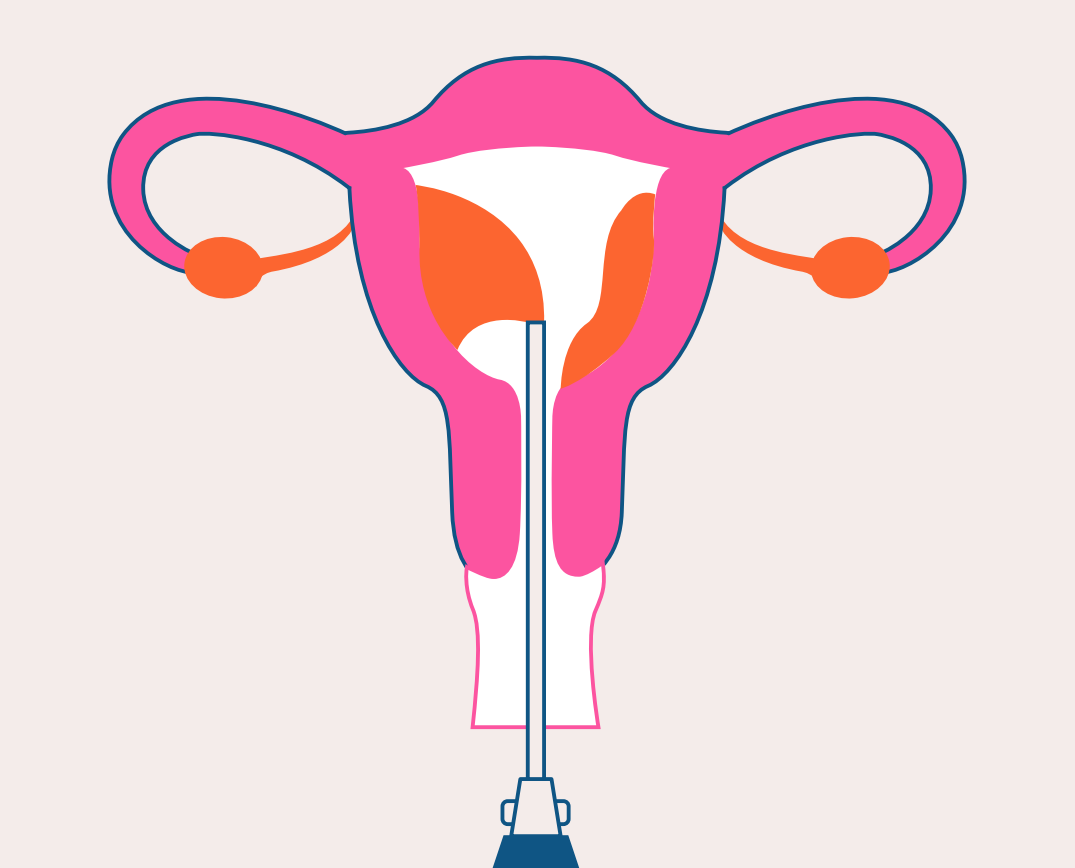 Guide to safe abortion through surgery with pictures : 성적권리와 재생산정의를 위한 ...