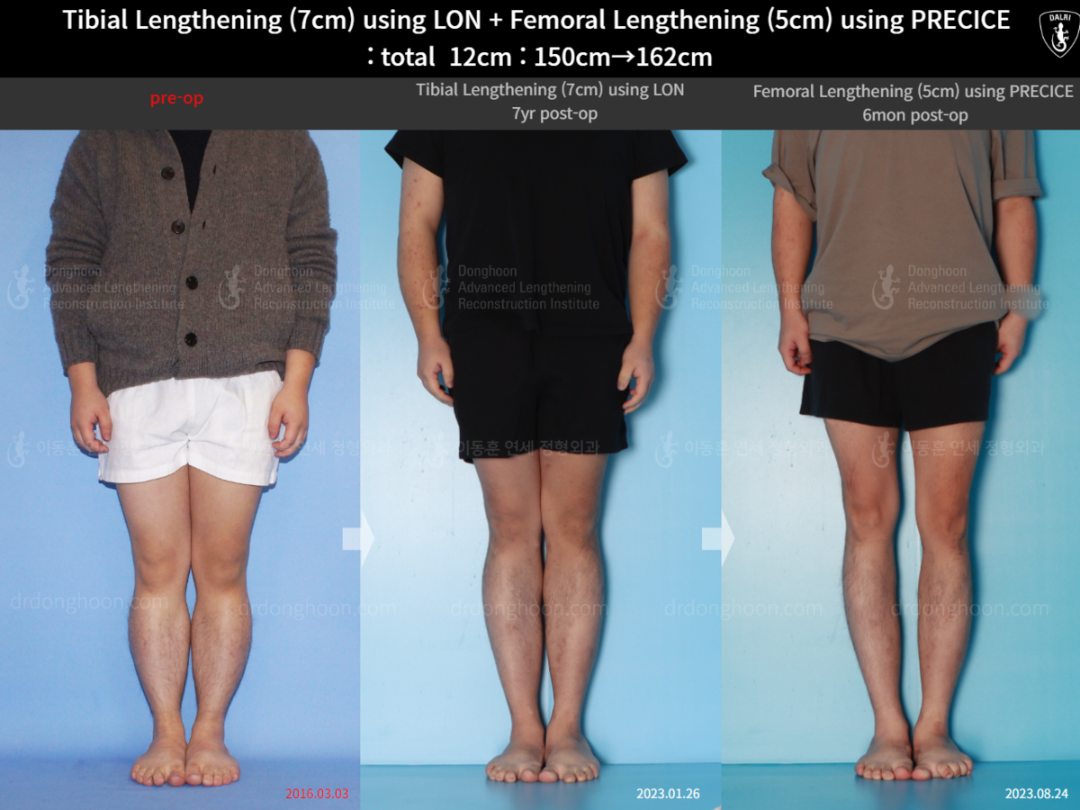 Tibial Lengthening (7cm) using LON + Femoral Lengthening (5cm) using ...