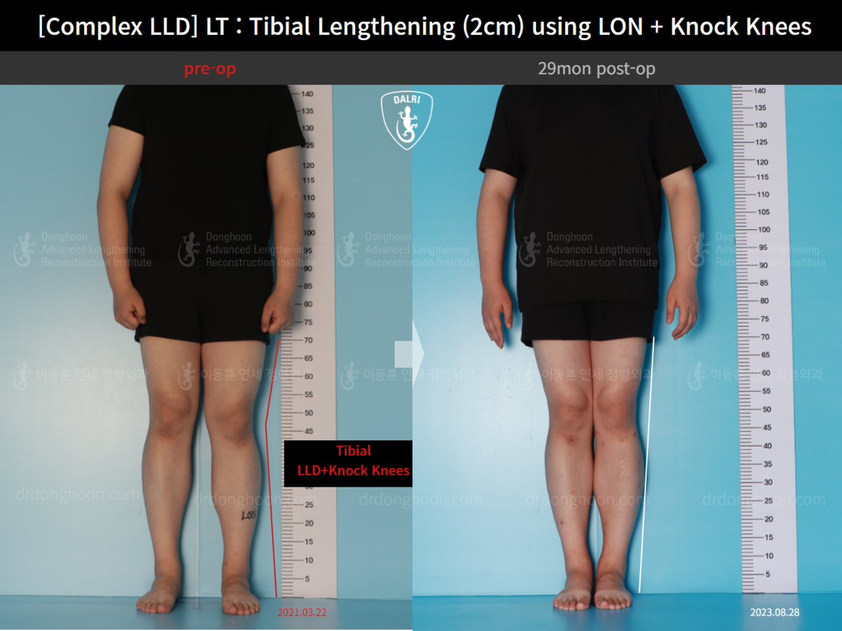 [Complex LLD] LT : Tibial Lengthening (2cm) using LON + Knock Knees ...