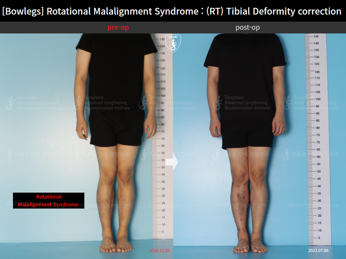[Bowlegs] Rotational Malalignment Syndrome : (RT) Tibial Deformity ...