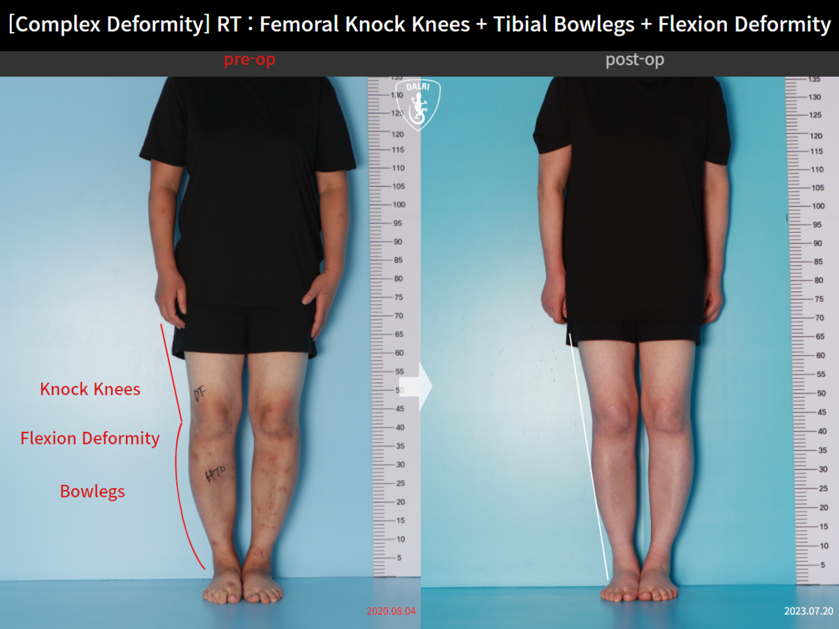 [Complex Deformity] RT : Femoral Knock Knees + Tibial Bowlegs + Flexion ...