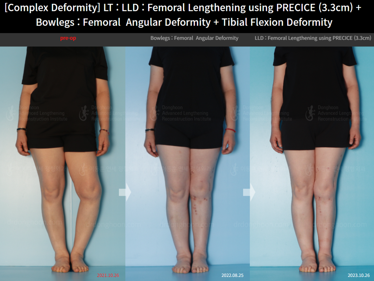 [Complex Deformity] LT : LLD : Femoral Lengthening using PRECICE (3.3cm ...