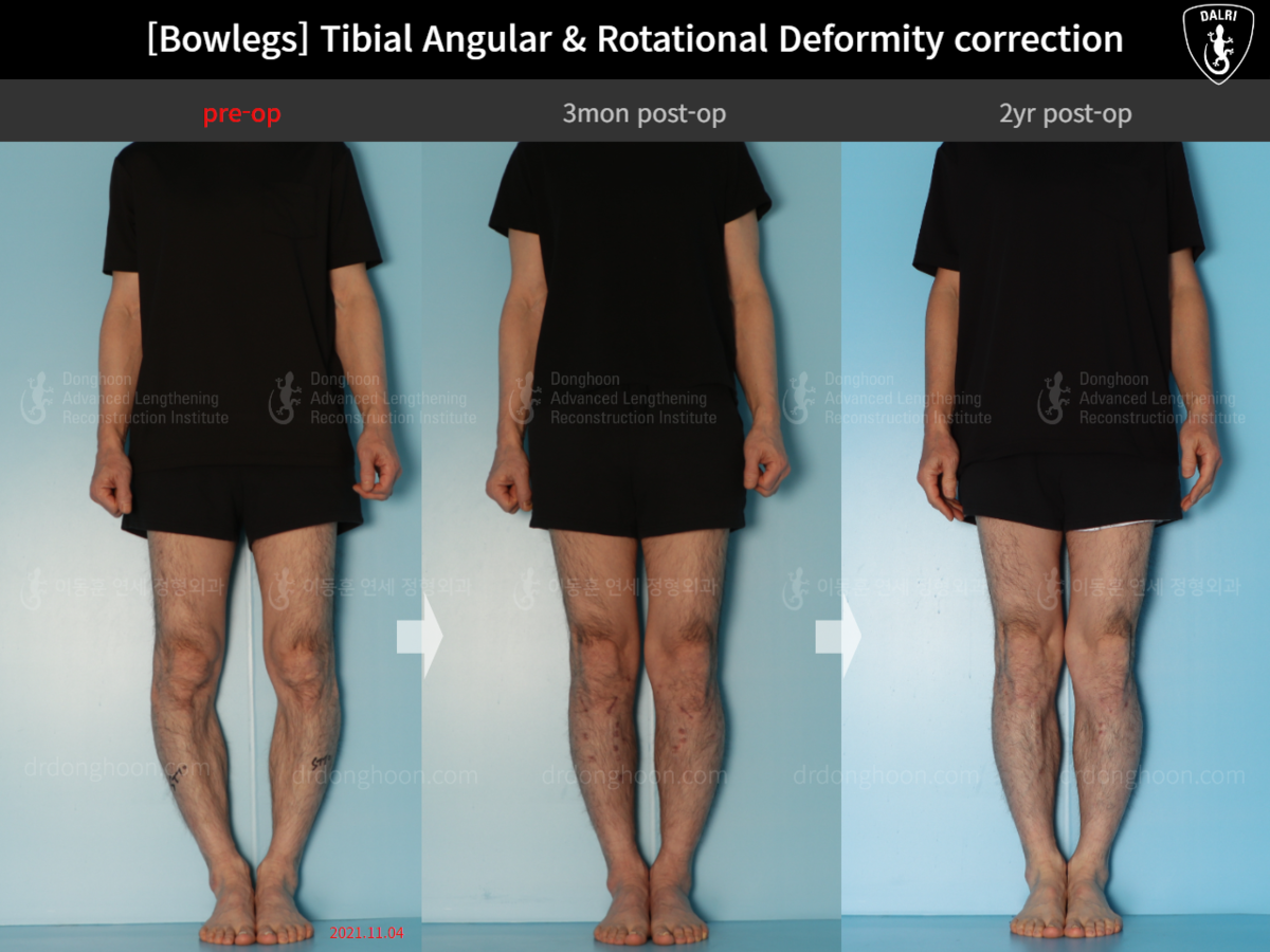 [Bowlegs] Tibial Angular & Rotational Deformity correction : 3mon post ...