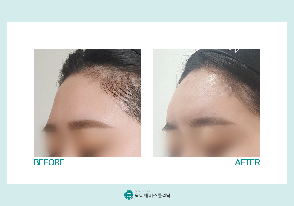 [인천점] 이마필러4cc : Dr.Evers 施术前/后照片
