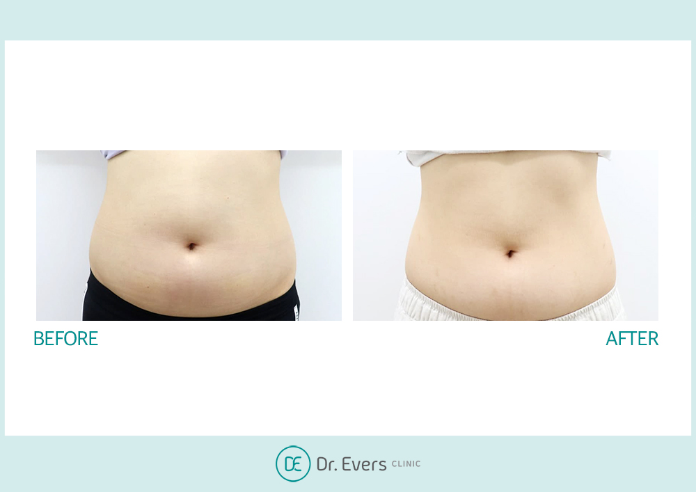 [Dr.Evers Clinic Incheon Branch] Girl group Injection : Dr.Evers Korea Dermatology Seoul Hongdae ...