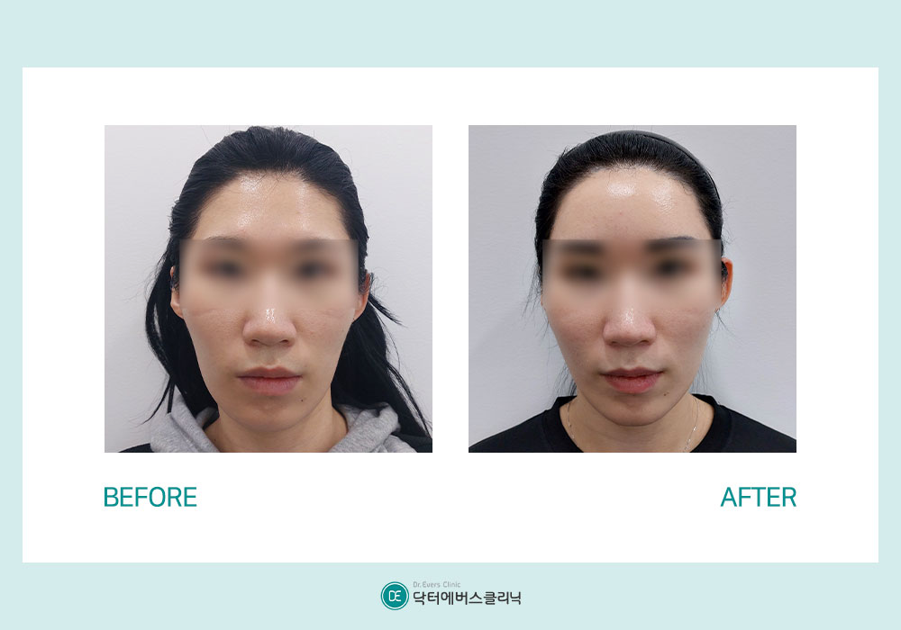[Cheongna] Front/Side Cheek UltraCol 200 + Juvelook Volume + Forehead ...