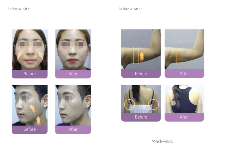 Are fat dissolve injections safe? : Medi-fella | Blog