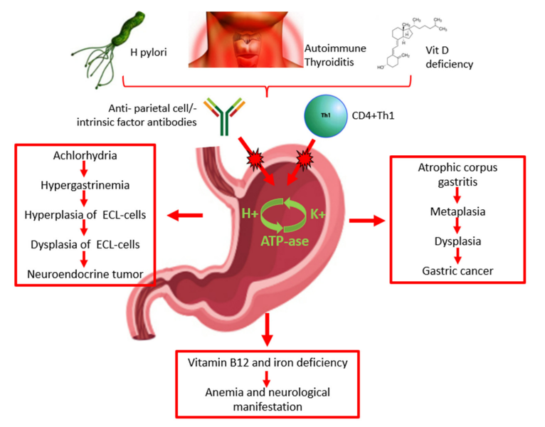 Autoimmune Atrophic Gastritis: A Clinical Review : 대한자가면역성위염연구회