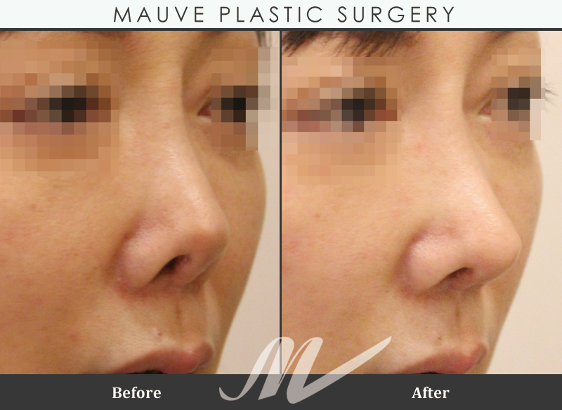 구축으로 인한 2번째 코재수술 개선 사례 코재수술 구축코연장콧대코끝연장귀연골 성형외과 전문의 칼럼 코성형 가슴성형 수술 사례 오똑한 콧날 낮은코 짧은 코끝