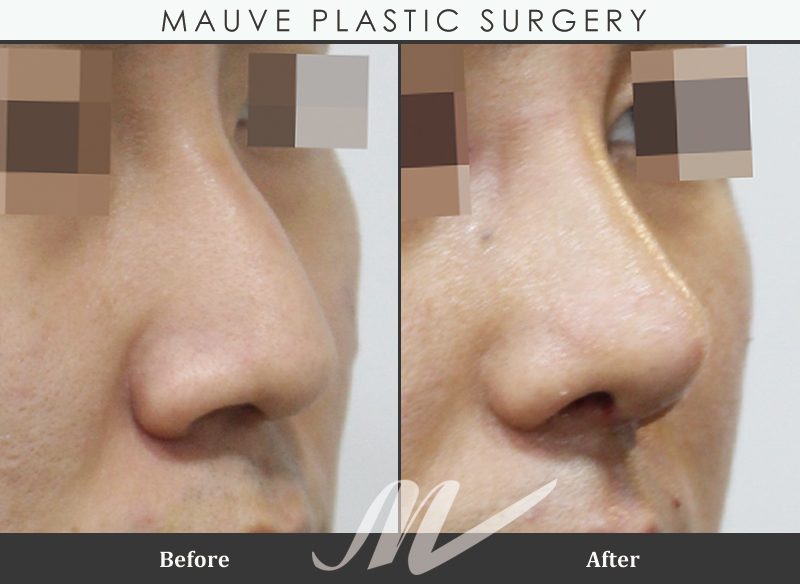 하이코시술로 개선되지 않은 매부리코 개선사례 코성형 콧대코끝하이코제거 성형외과 전문의 칼럼 코성형 가슴성형 수술 사례 오똑한 콧날 낮은코 짧은 코끝 콧대