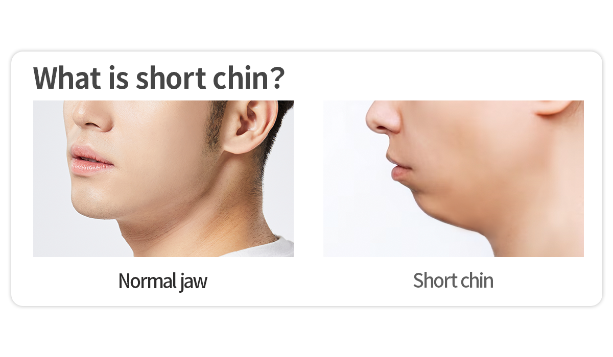 [Girin Plastic Surgery] The Importance of Design in a Male Chin Filler ...