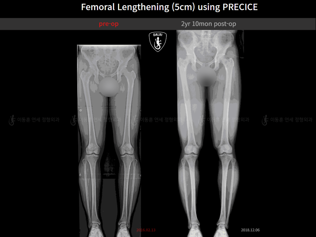 Femoral Lengthening (5cm) using PRECICE : 2yr post-op : CLL PRECICE