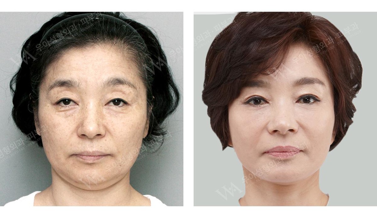 Anti-aging_7 : COCO KOREA PLASTIC SURGERY
