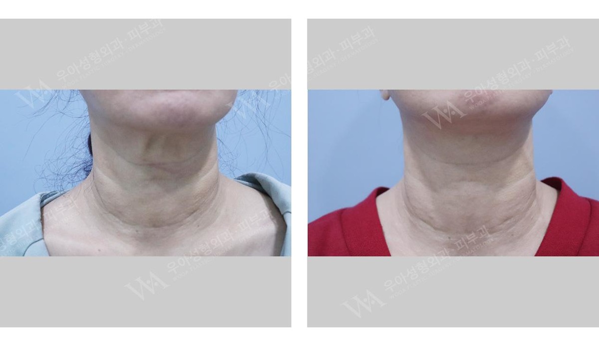 Anti-aging_5 : COCO KOREA PLASTIC SURGERY