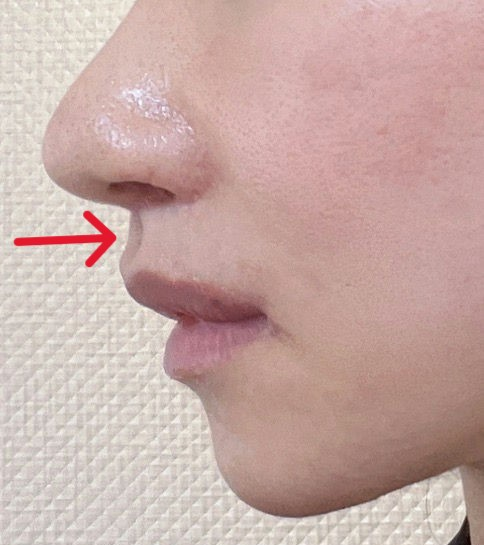Philtrum Contouring Surgery (C-Curl Procedure): Everything You Need to ...