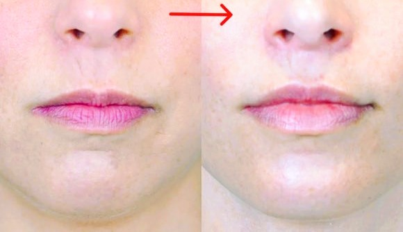 Everything You Need to Know About Philtrum Reduction Surgery: Cost ...