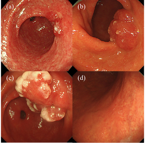 (Japan) Revealing autoimmune gastritis: Polypoid nodule scar ...